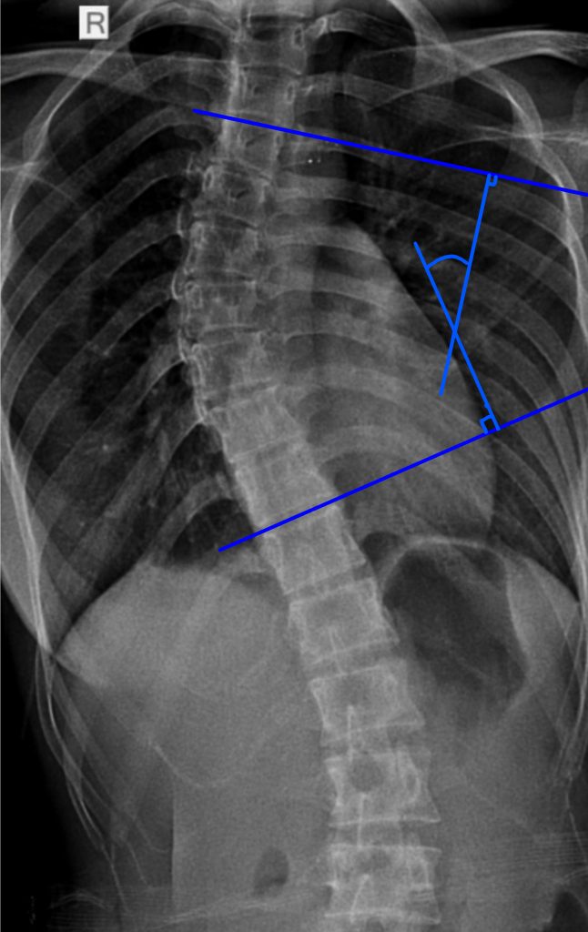 19 Essential Scoliosis Facts About Spinal Curvature Revealed - Facts.net