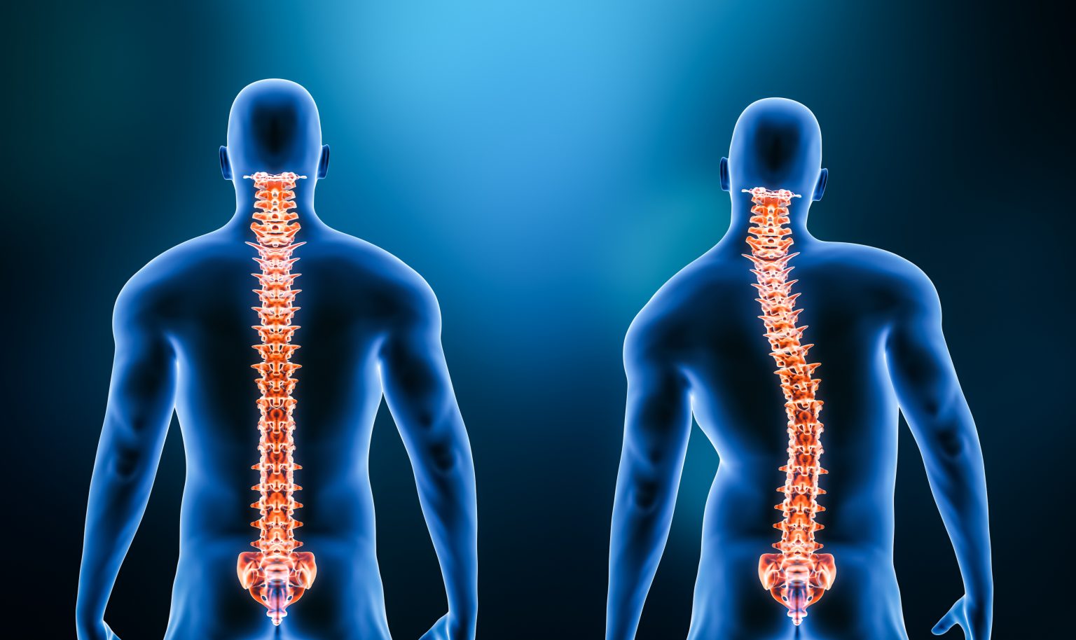 19 Essential Scoliosis Facts About Spinal Curvature Revealed - Facts.net