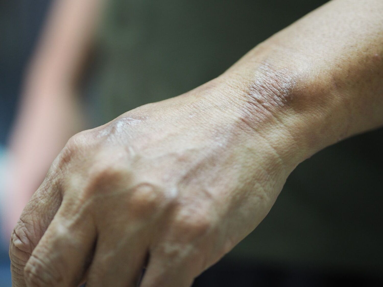 13 Great Facts About Leprosy - Facts.net