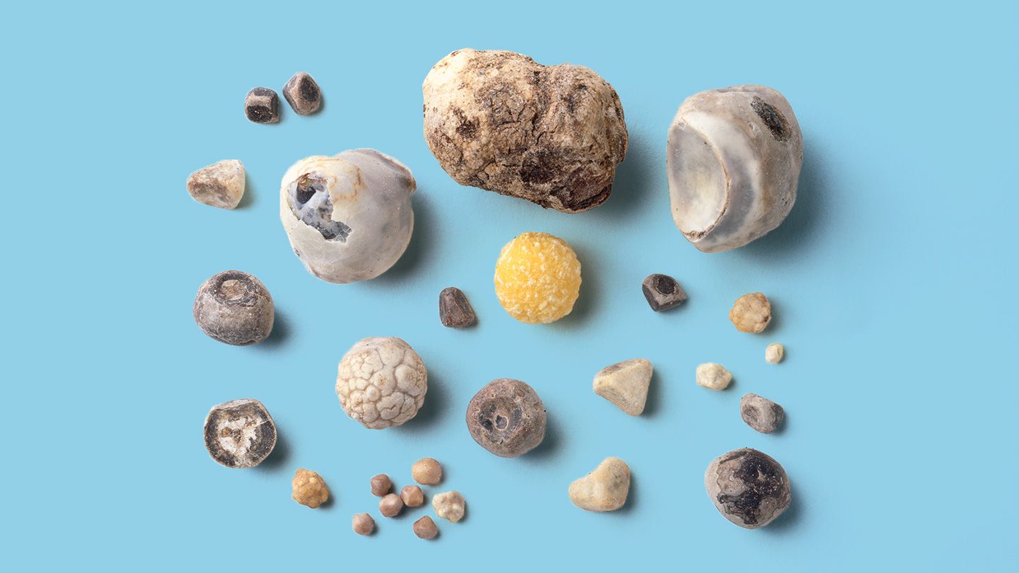 18 Facts About Gallstones - Facts.net